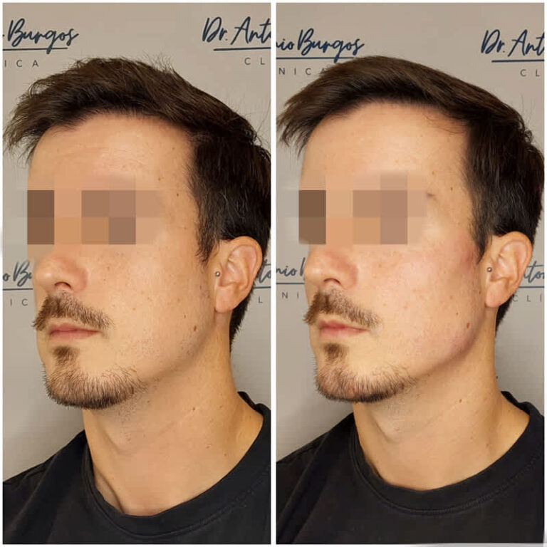 Marcación Mandibular Málaga | Clínica Dr. Antonio Burgos